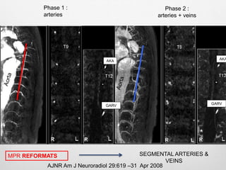 Spinal Cord Magnetic Resonance Angiography - Spinal MRA | PPTX