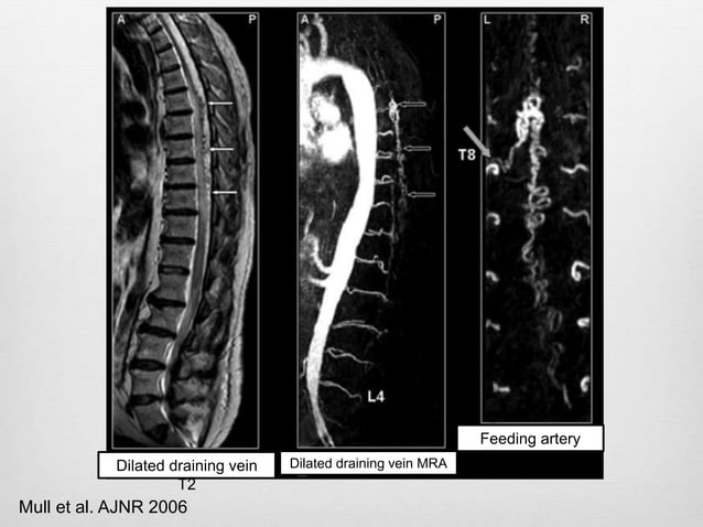 Spinal Cord Magnetic Resonance Angiography - Spinal MRA | PPT