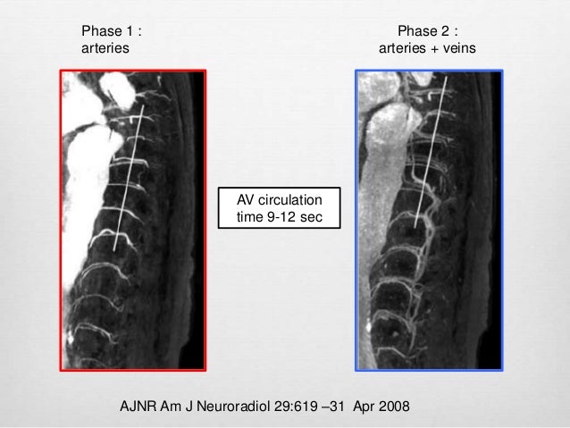 Spinal Cord Magnetic Resonance Angiography - Spinal MRA