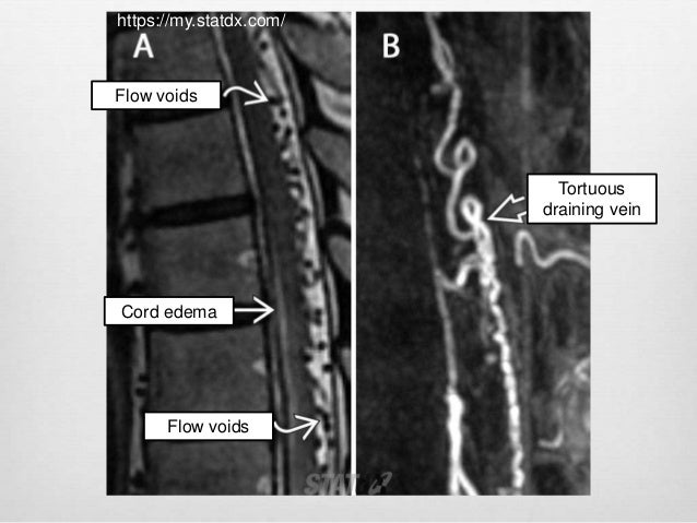 Spinal Cord Magnetic Resonance Angiography - Spinal MRA