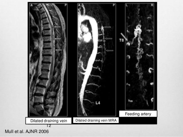 Spinal Cord Magnetic Resonance Angiography - Spinal MRA