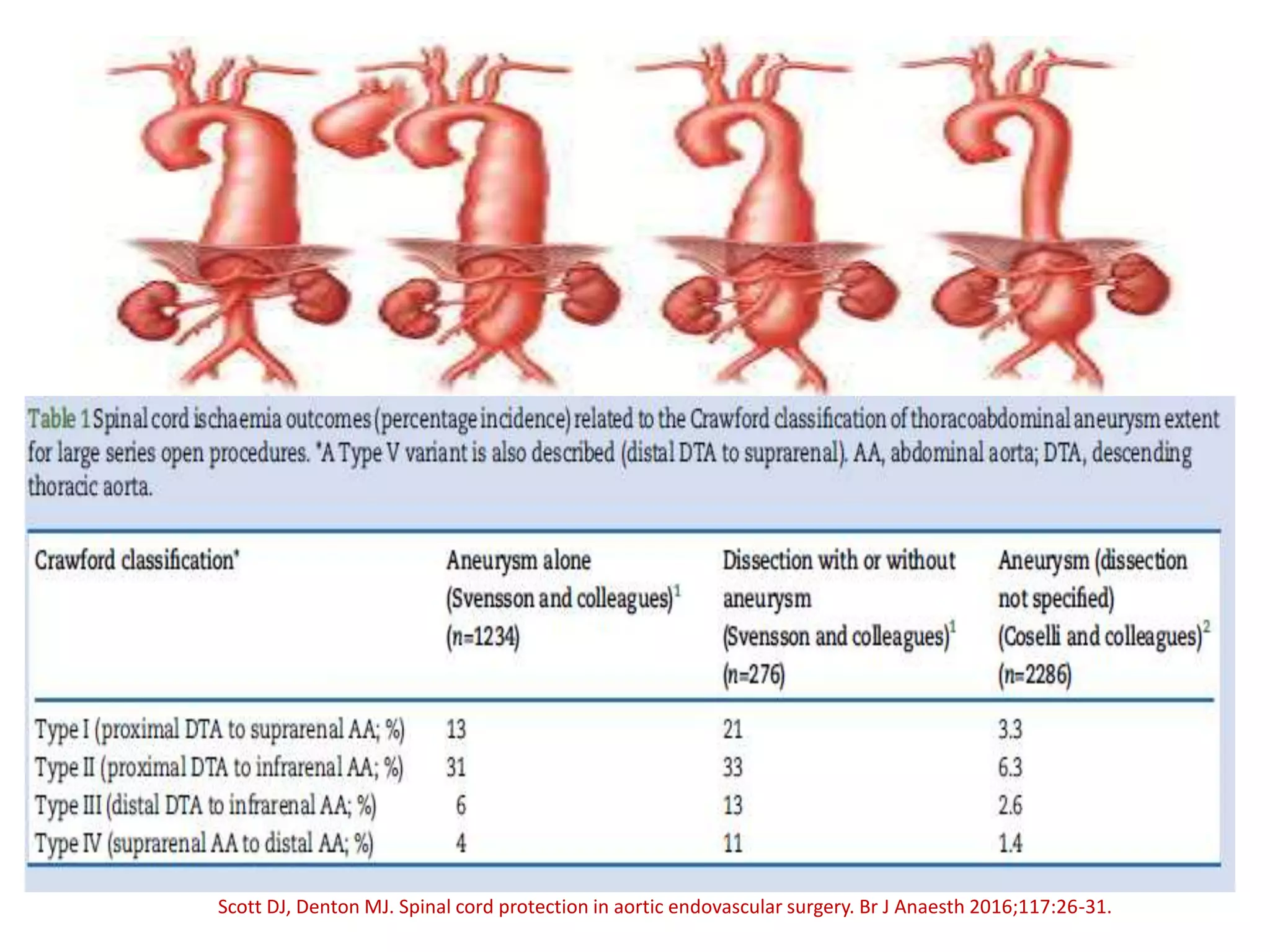 Spinal cord protection in aortic surgeries | PPTX