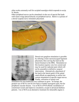 Spinal Cord Stimulation Primer | DOC