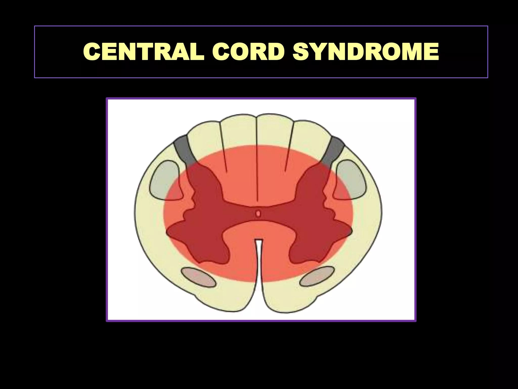 Spinal cord syndromes | PPSX