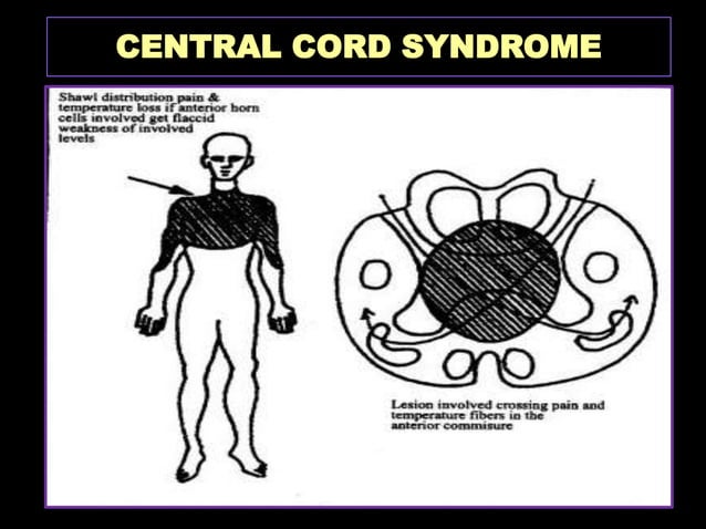 Spinal cord syndromes | PPSX | Physical Therapy | Wellness