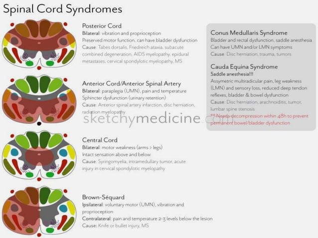 Spinal cord syndromes | PPSX | Physical Therapy | Wellness