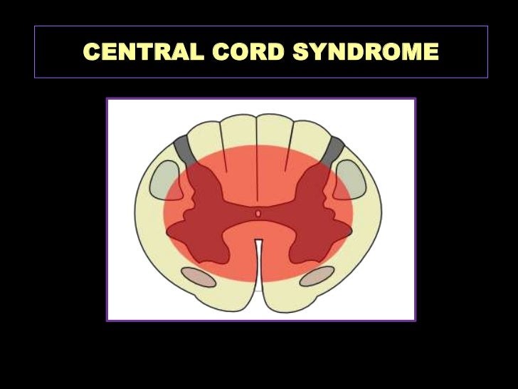 Spinal cord syndromes