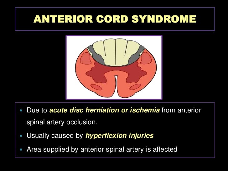 Anterior Cord Syndrome