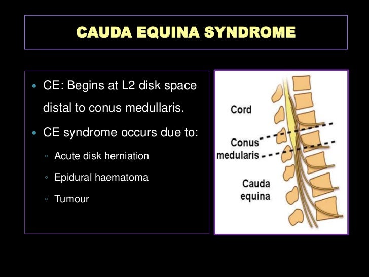 Cauda Equina Syndrome Vs Conus Medullaris Syndrome