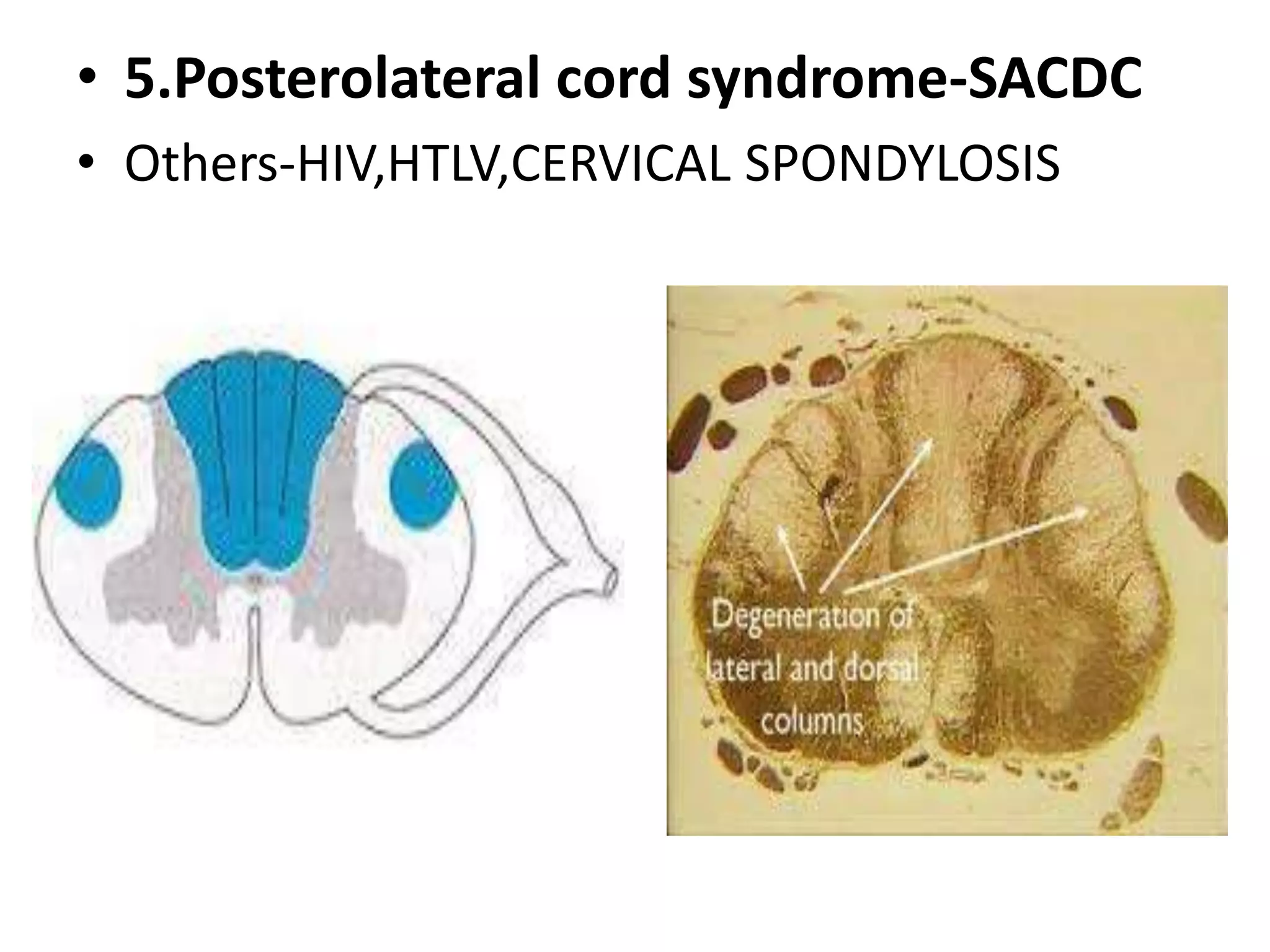 Spinal Cord Syndromes-An Overveiw | PPTX
