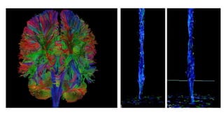 Spinal cord tractography | PPT