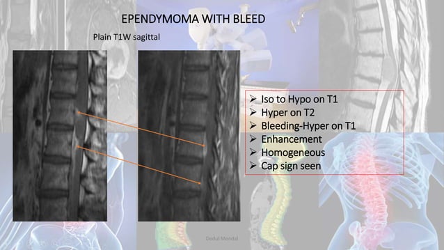 Spinal cord tumor | PPTX | Brain and Nervous System Disorders ...