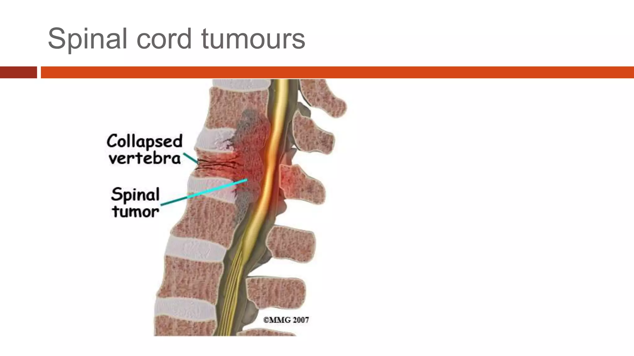 Spinal cord tumors | PPTX