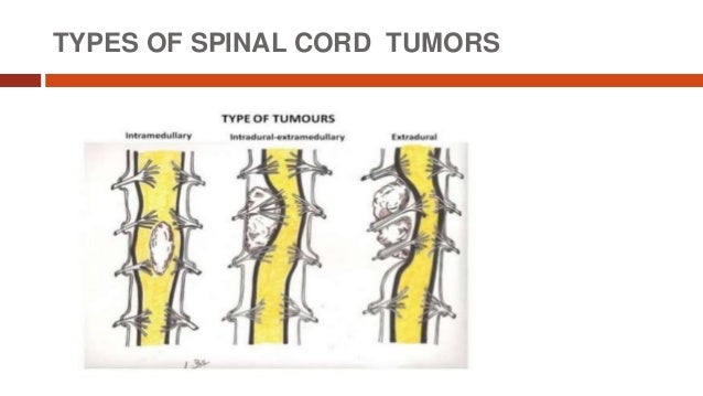 Spinal Cord Tumors