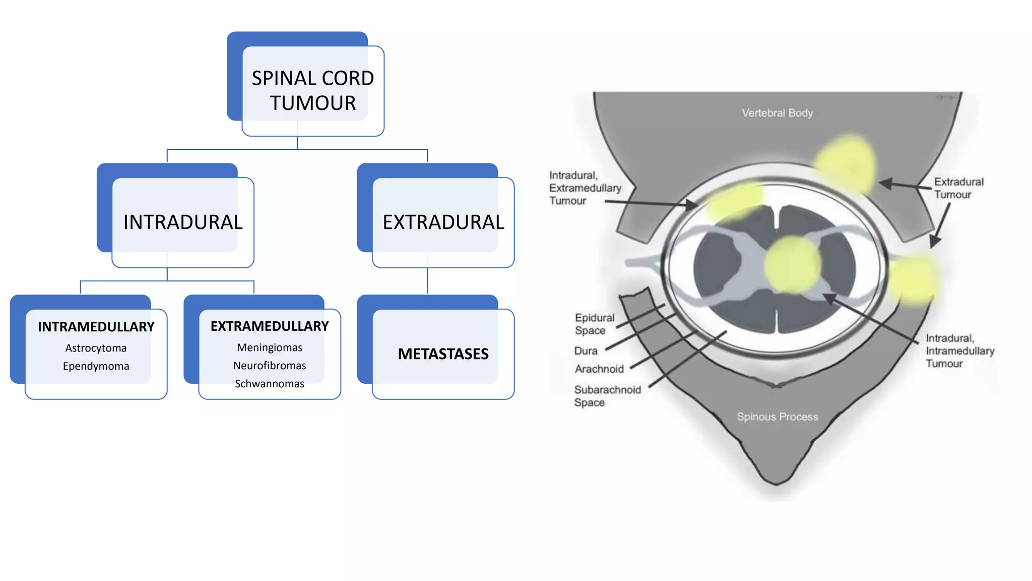 SPINAL CORD TUMOUR.pptx