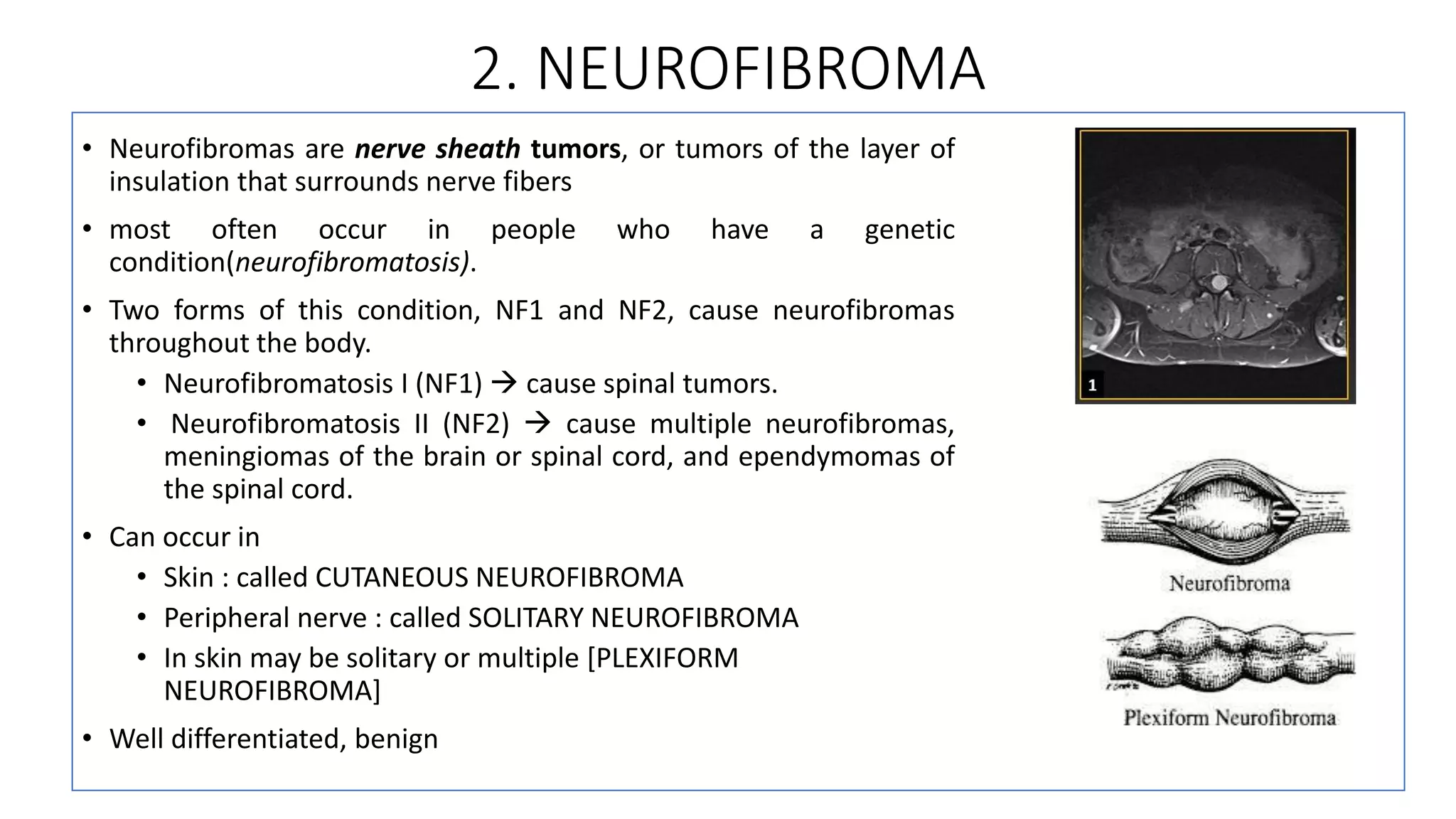 SPINAL CORD TUMOUR.pptx