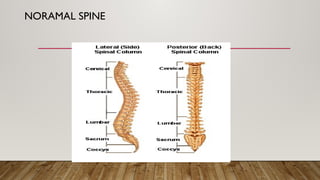 spinal cord deformities and their management.pptx