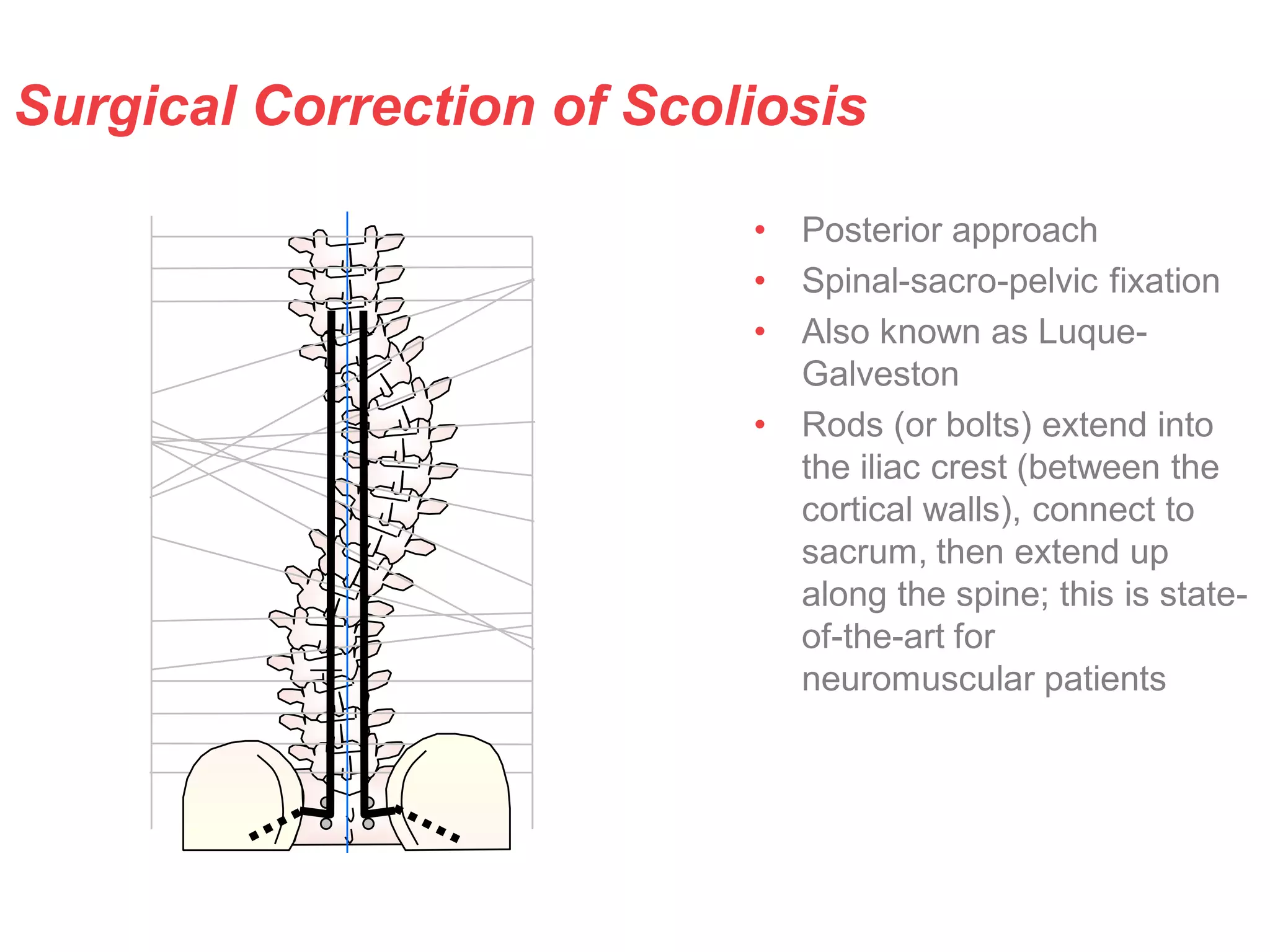 Scoliosis Lecture by Professor Dr. Md. Shah Alam | PDF