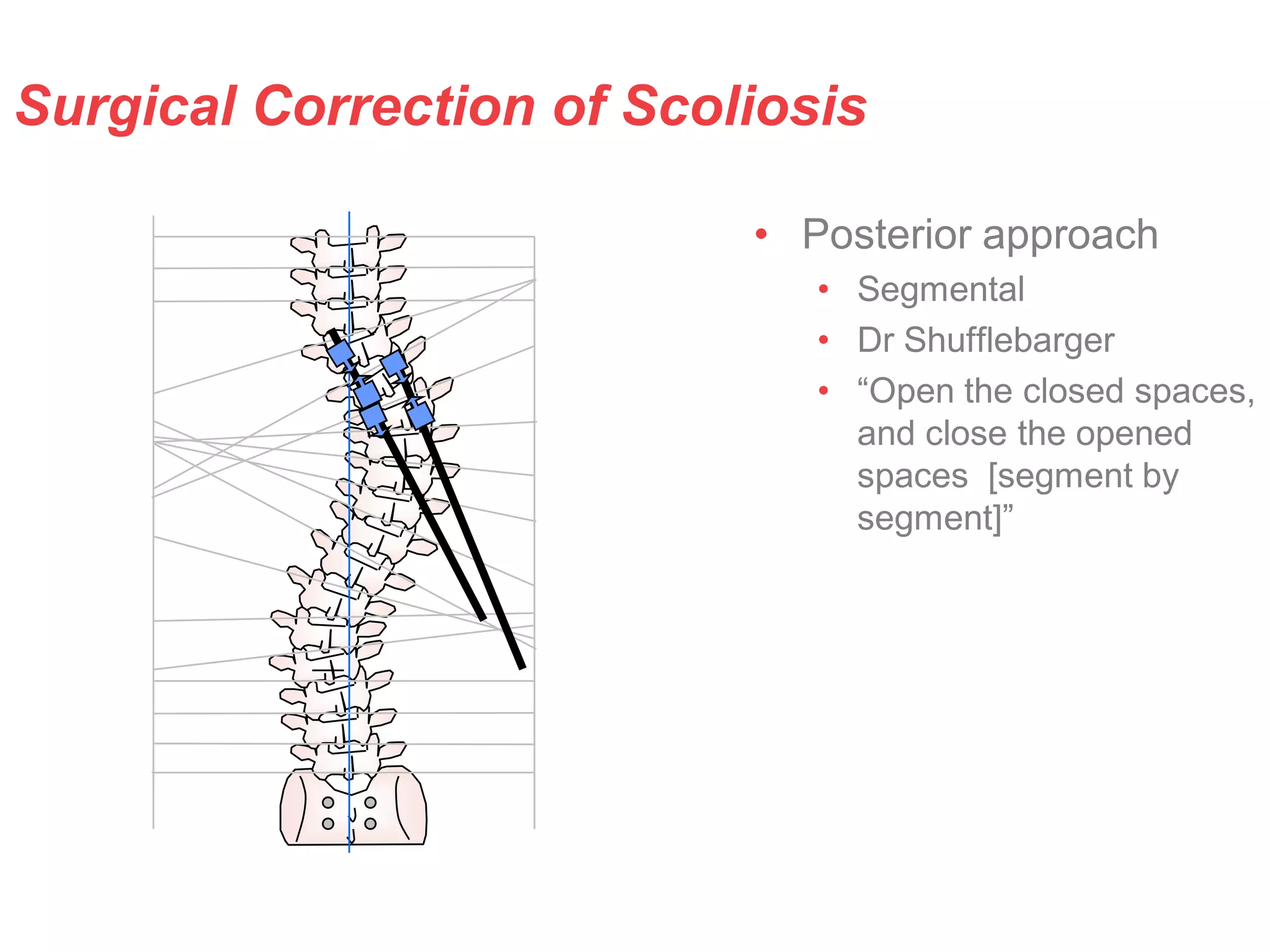 Scoliosis Lecture by Professor Dr. Md. Shah Alam | PDF