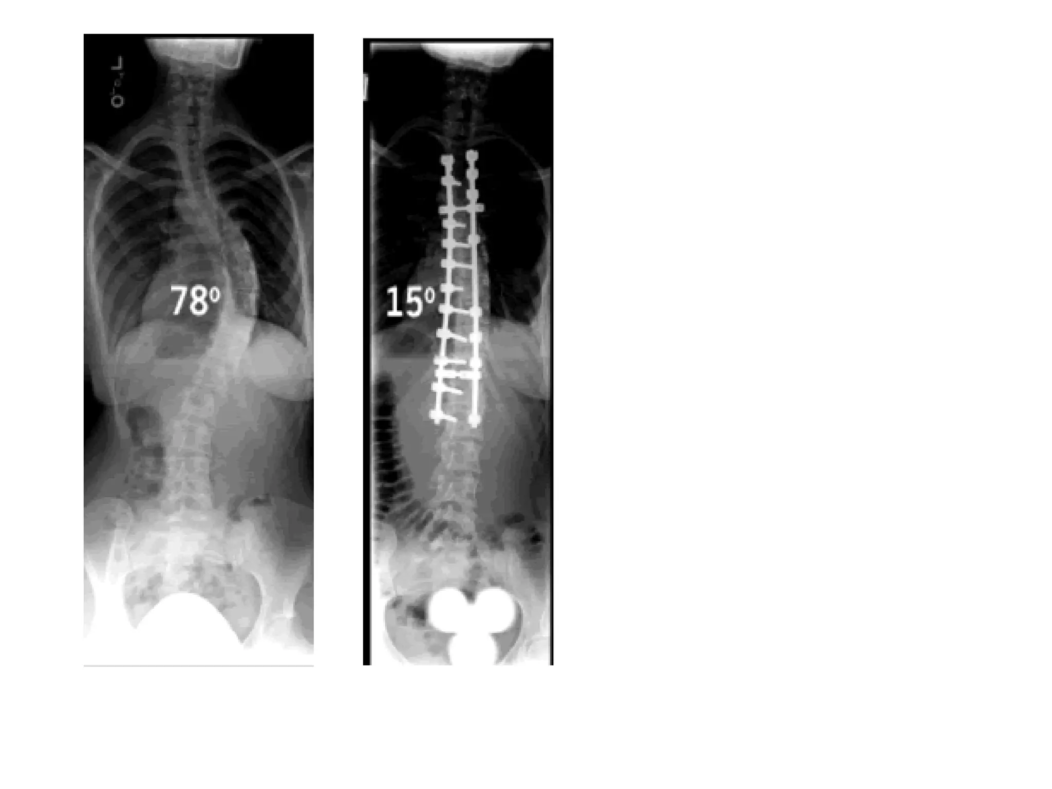 Scoliosis Lecture by Professor Dr. Md. Shah Alam | PDF