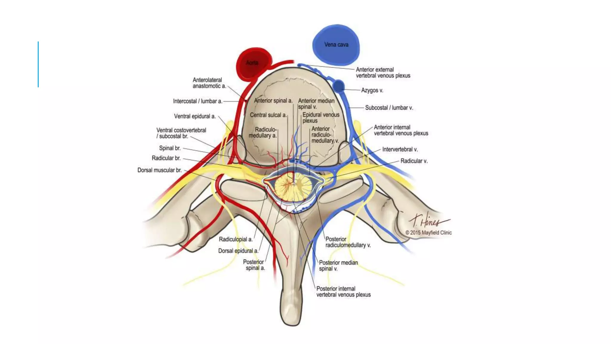 Spinal Dural Arteriovenous Fistula | PPTX