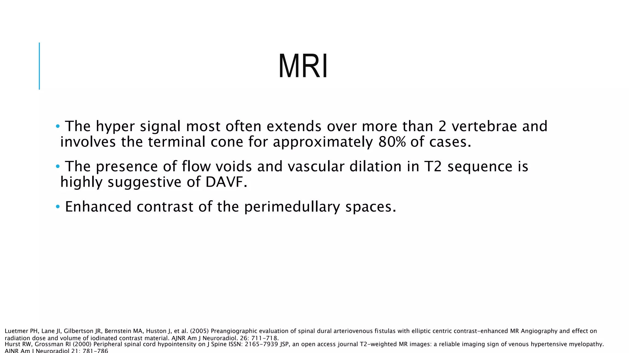 Spinal Dural Arteriovenous Fistula | PPTX
