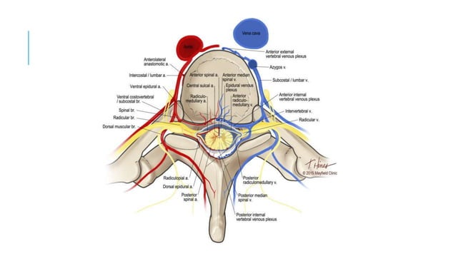 Spinal Dural Arteriovenous Fistula