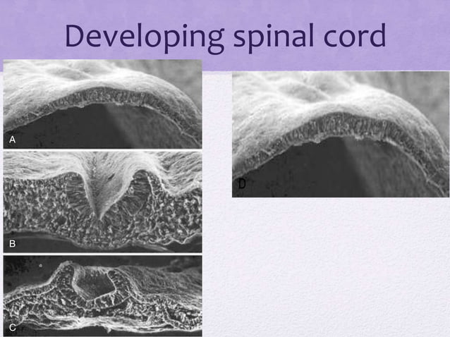 Spinal dysraphism | PPTX