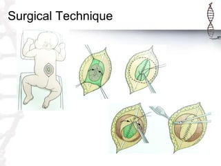 Spinal dysraphism and its management | PPTX