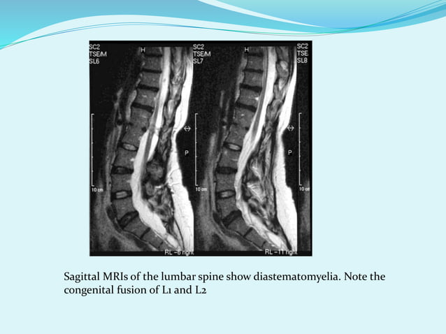 Spinal dysraphism