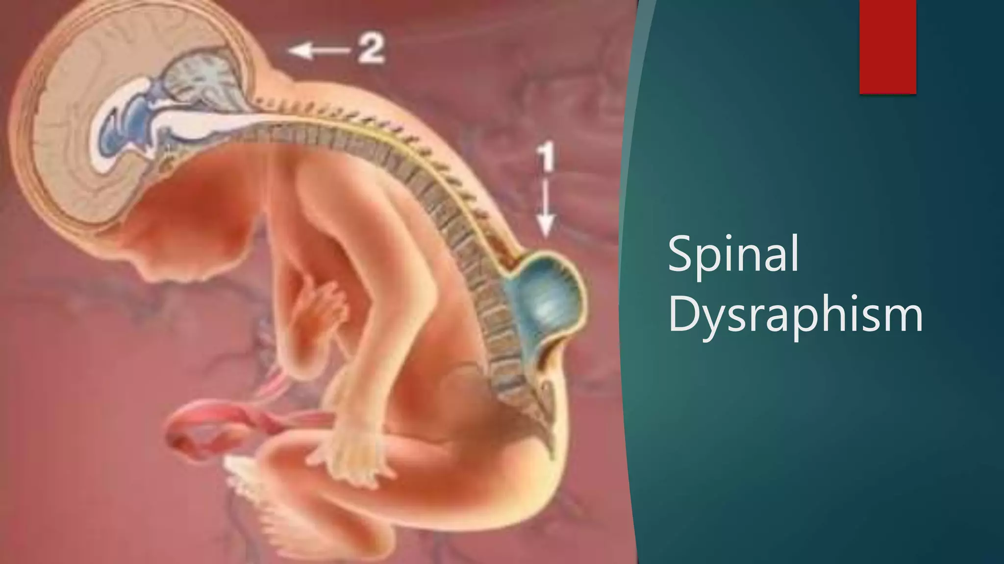 Spinal Dysraphism Pptx