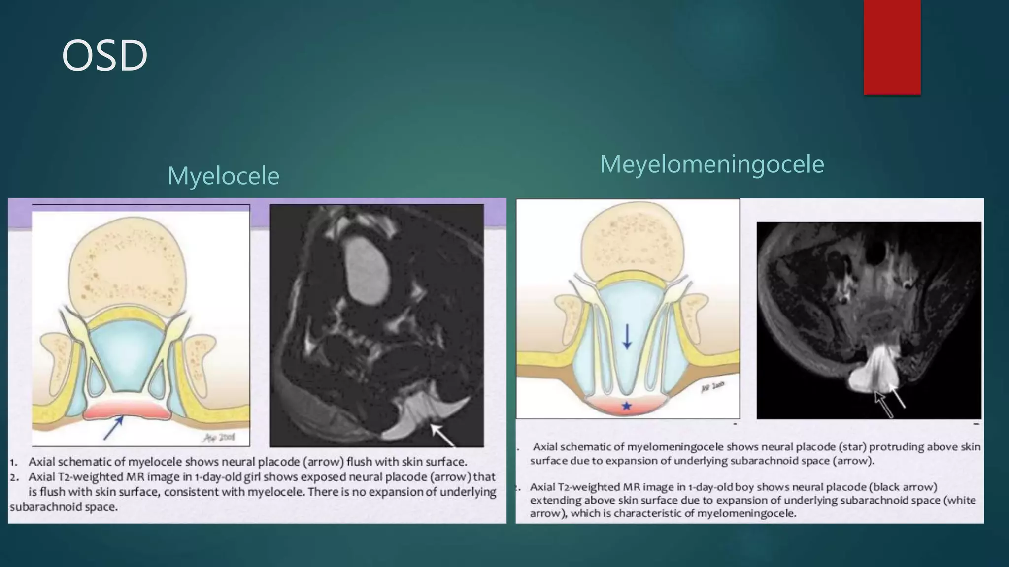 Spinal Dysraphism Pptx