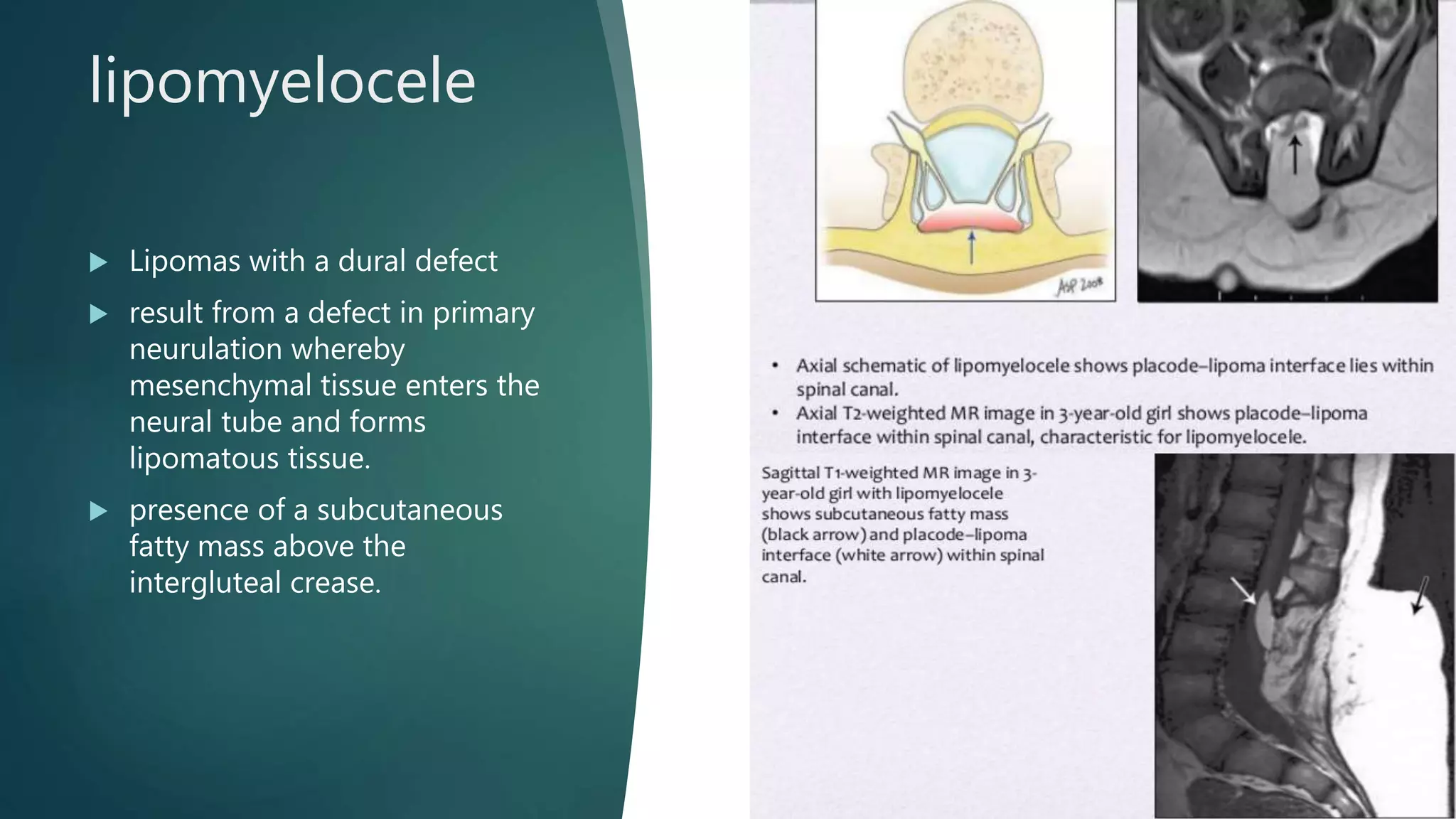 Spinal dysraphism | PPTX
