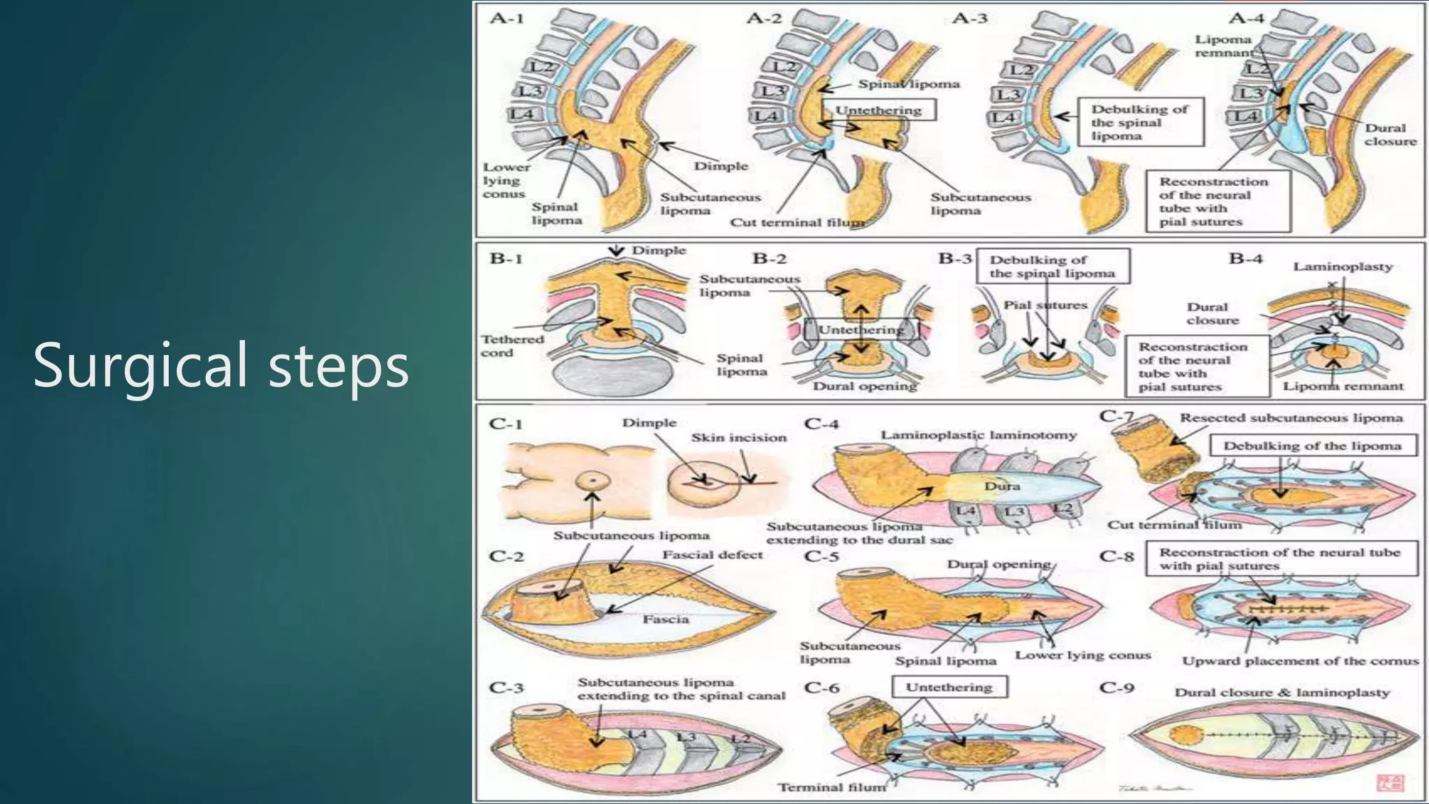 Spinal dysraphism | PPTX
