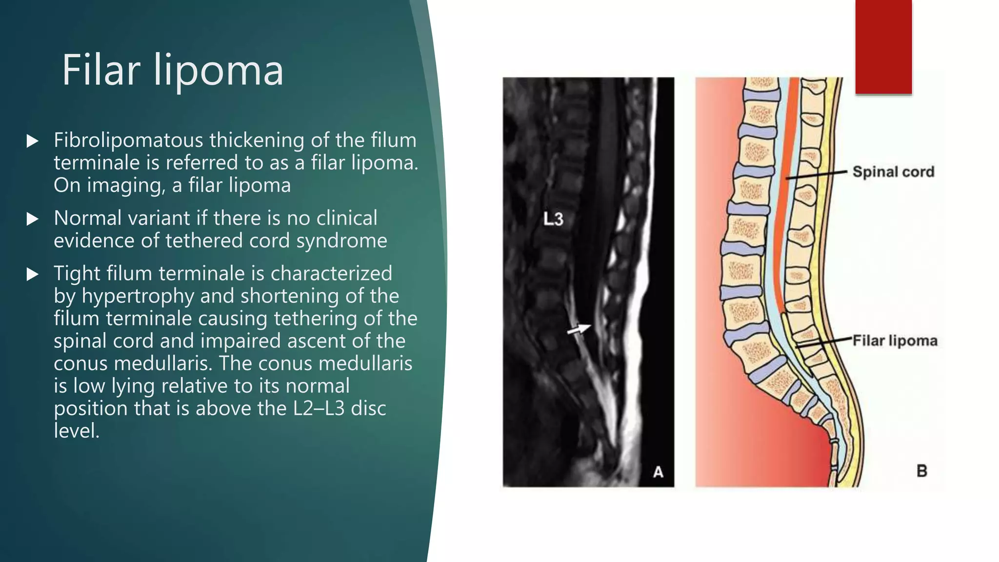 Spinal dysraphism | PPTX