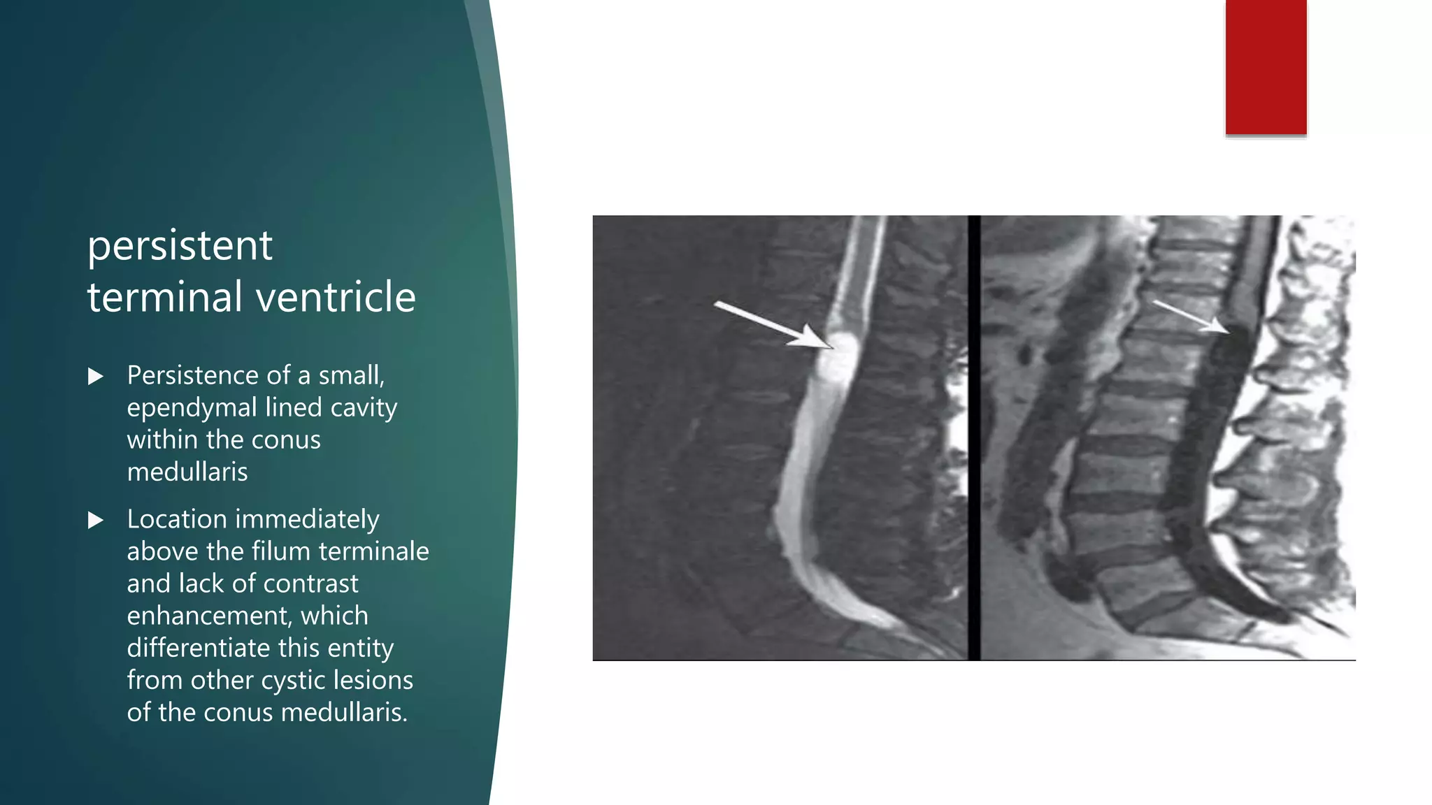 Spinal dysraphism | PPTX