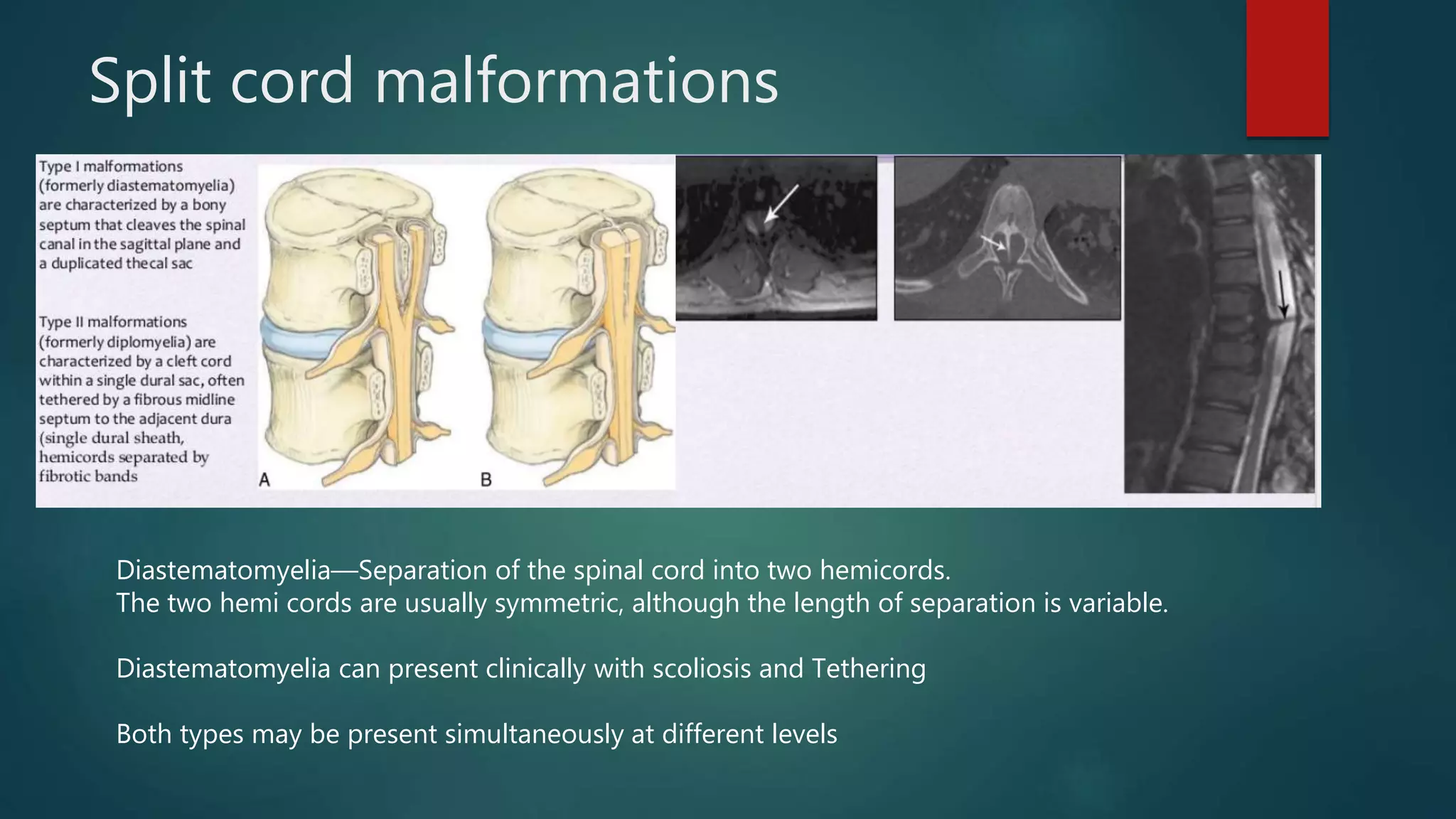 Spinal dysraphism | PPTX