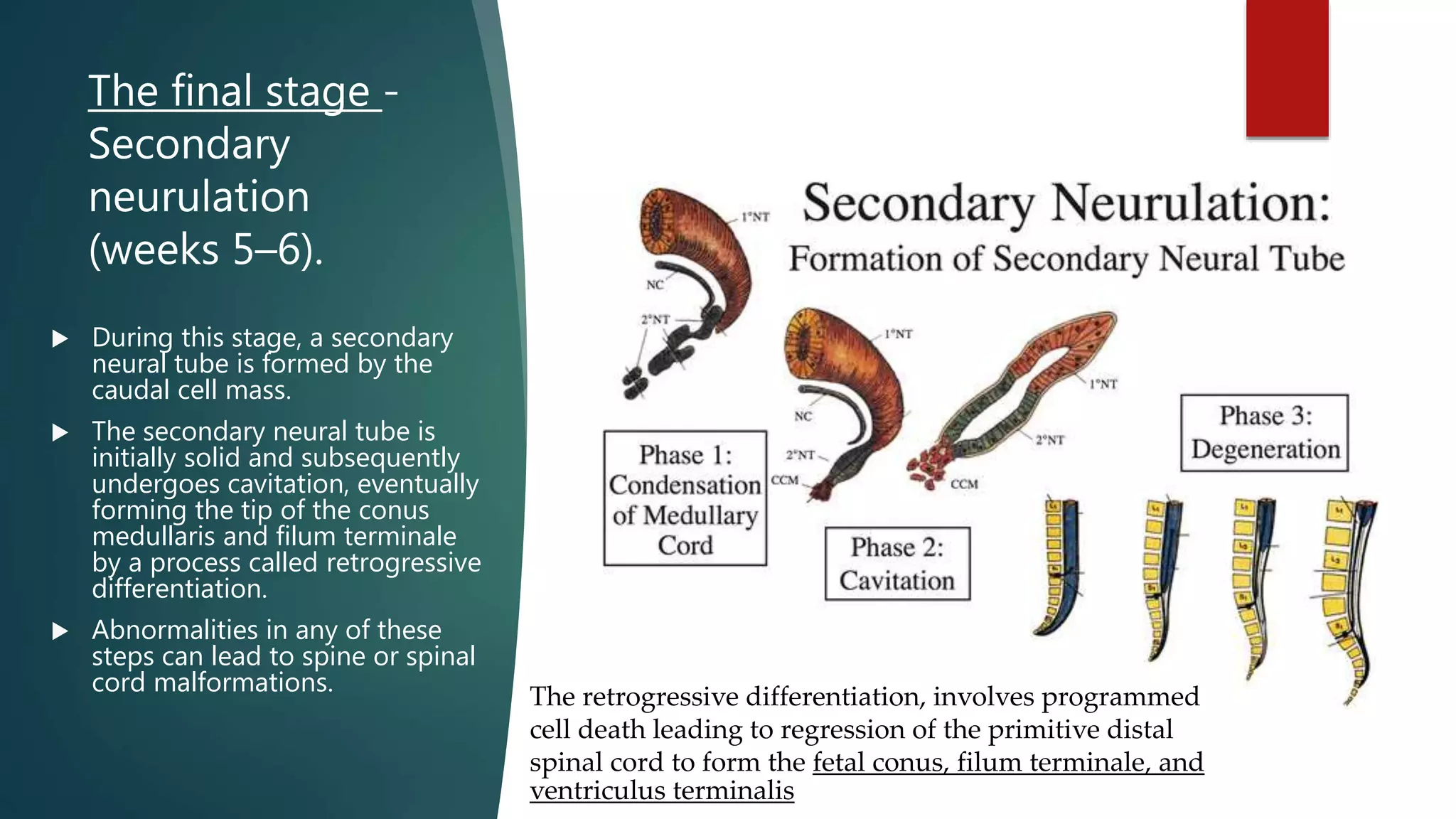 Spinal dysraphism | PPTX