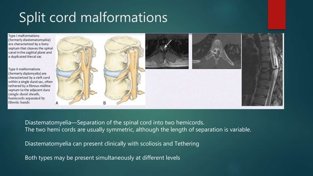Spinal dysraphism | PPTX
