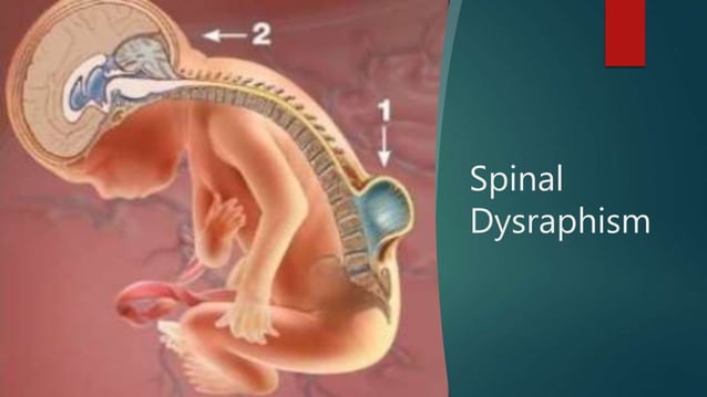Spinal dysraphism | PPT