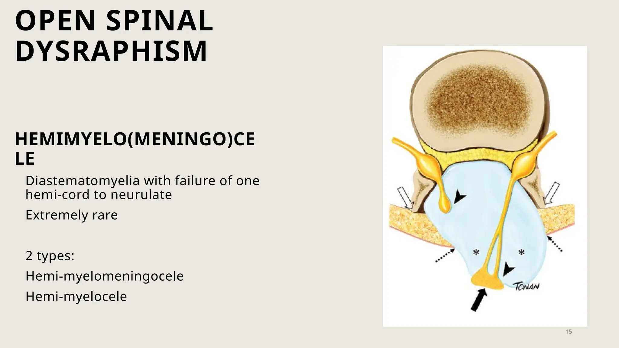 RADIOLOGICAL IMAGING IN CASES OF SPINAL DYSRAPHISM | PPTX