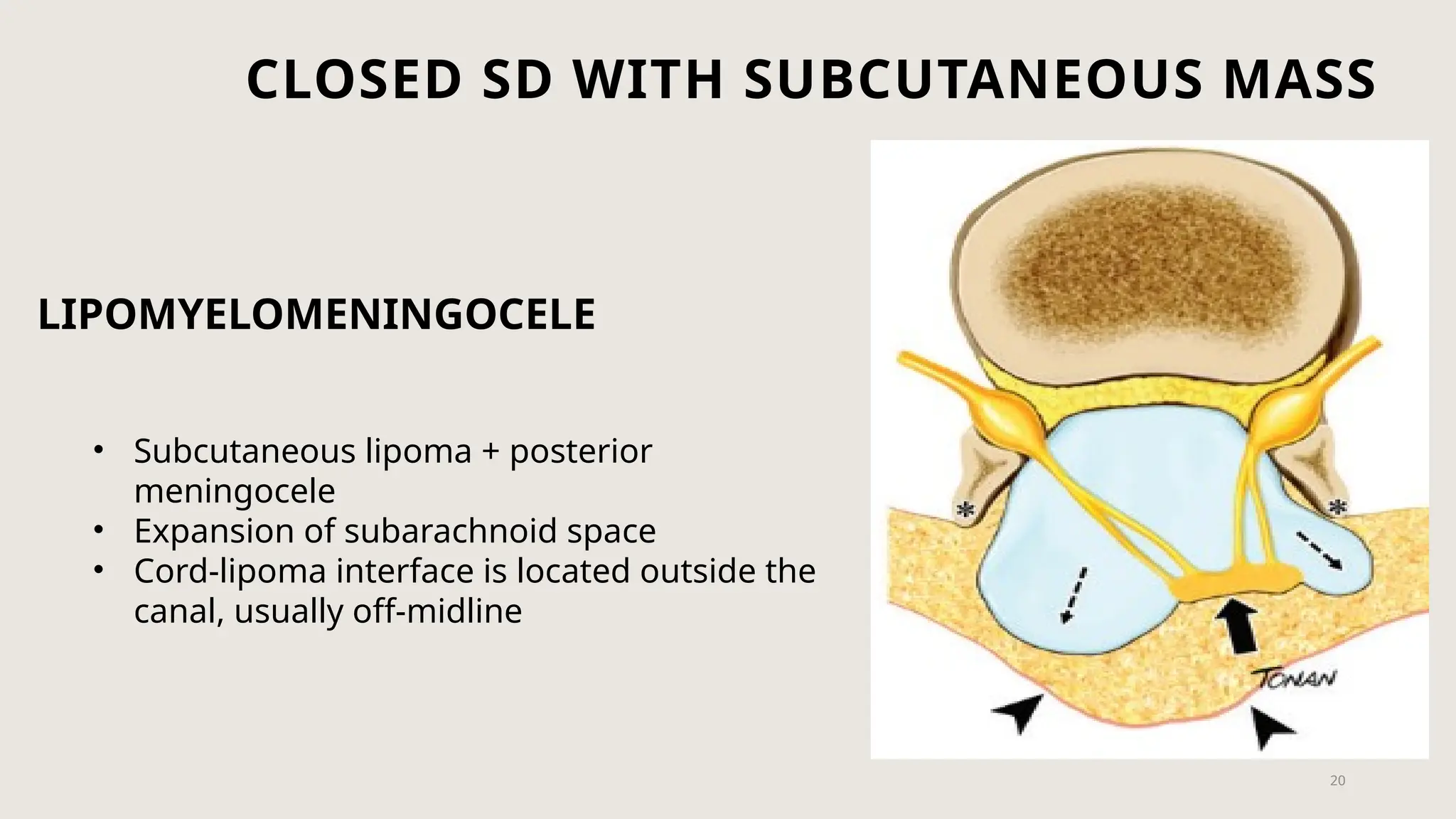 RADIOLOGICAL IMAGING IN CASES OF SPINAL DYSRAPHISM | PPTX