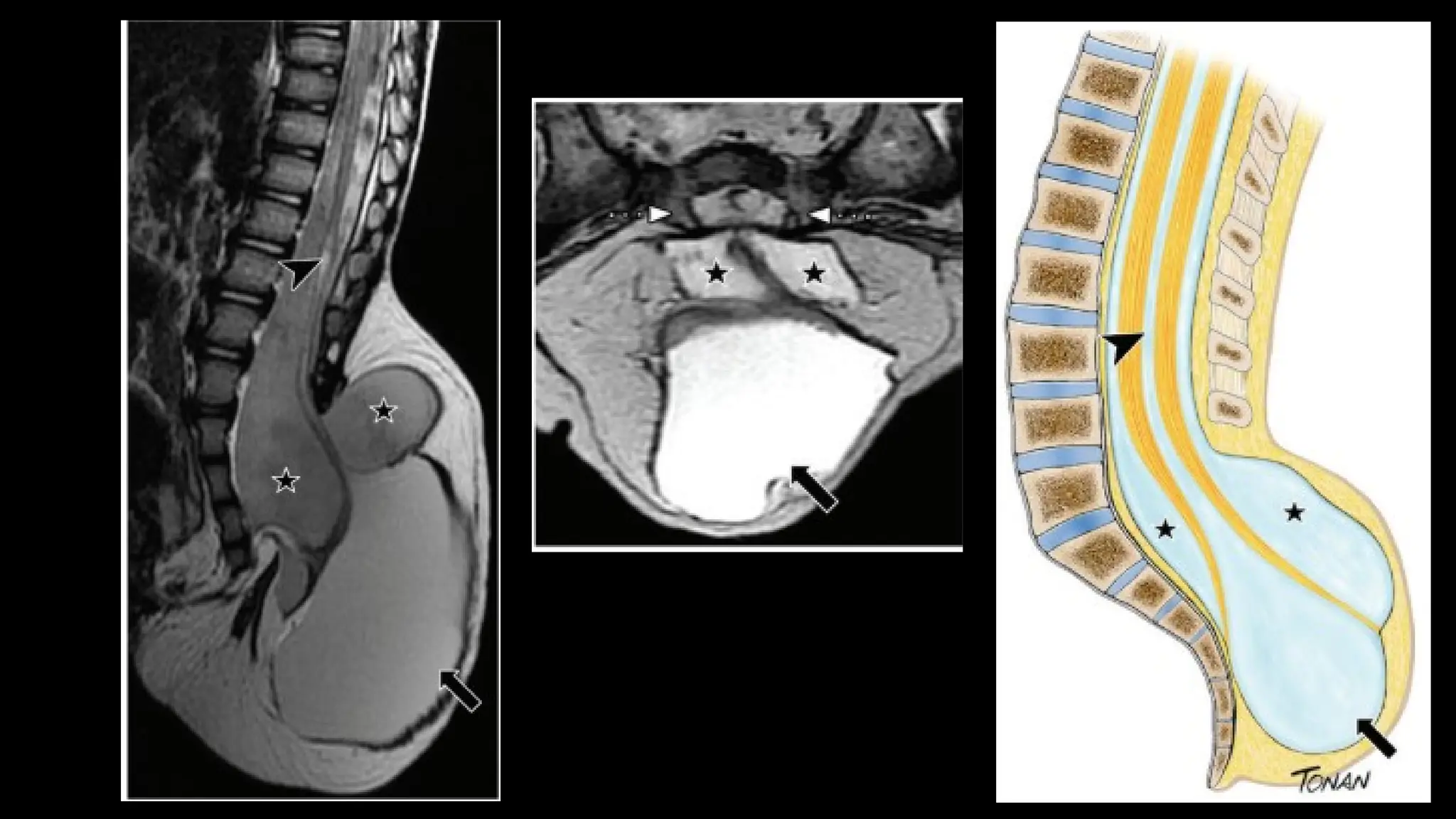 RADIOLOGICAL IMAGING IN CASES OF SPINAL DYSRAPHISM | PPTX