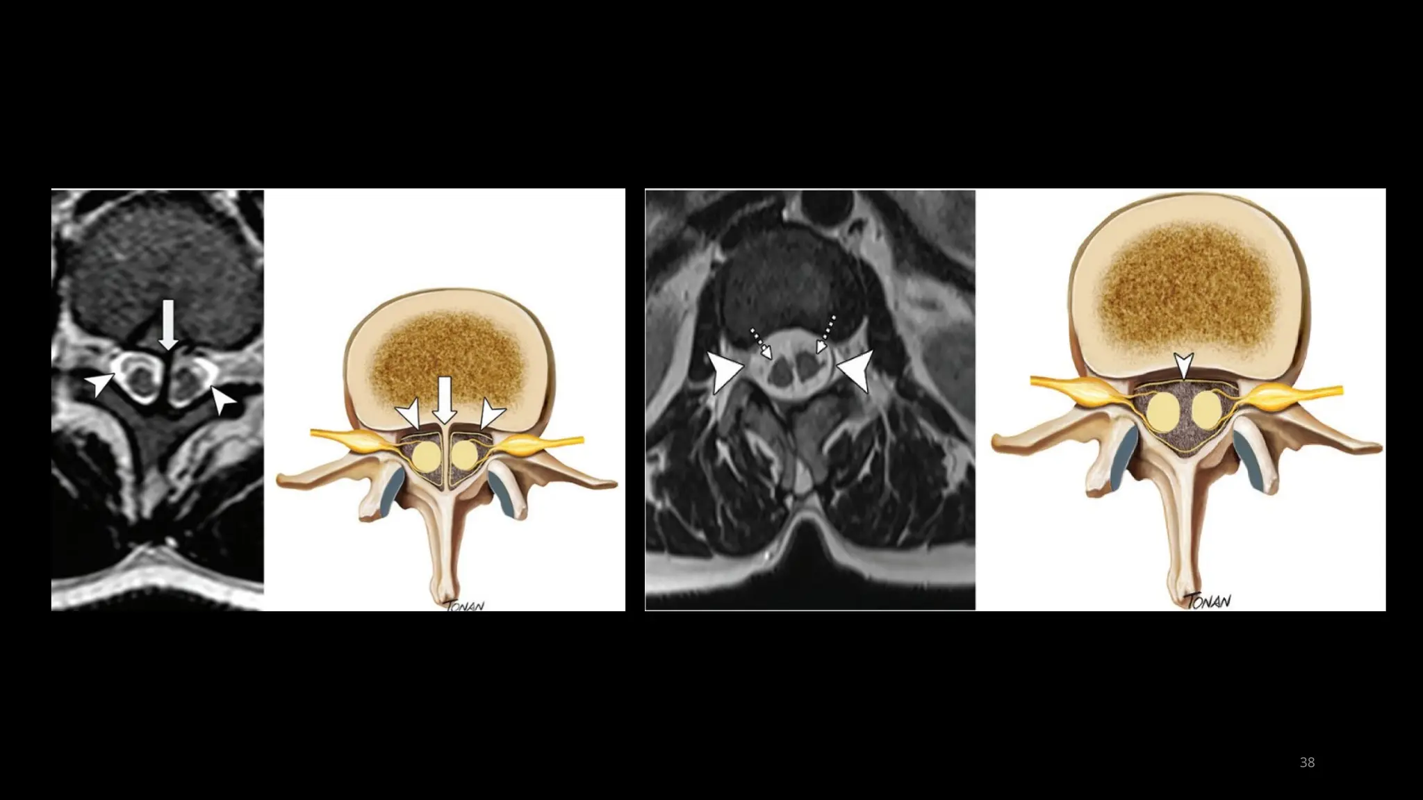 RADIOLOGICAL IMAGING IN CASES OF SPINAL DYSRAPHISM | PPTX