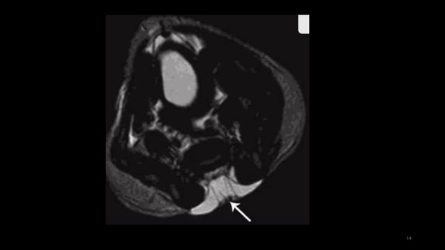RADIOLOGICAL IMAGING IN CASES OF SPINAL DYSRAPHISM | PPT