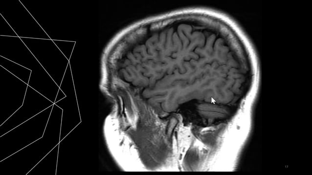 RADIOLOGICAL IMAGING IN CASES OF SPINAL DYSRAPHISM | PPT