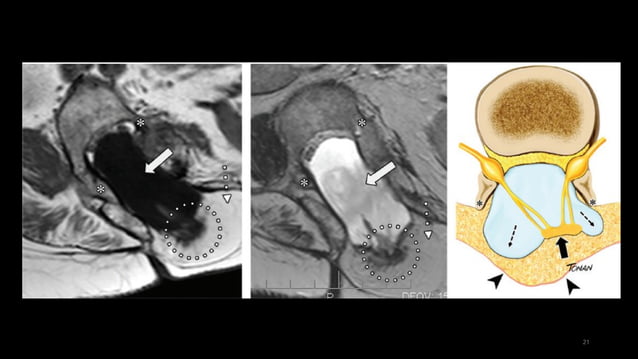 RADIOLOGICAL IMAGING IN CASES OF SPINAL DYSRAPHISM | PPT