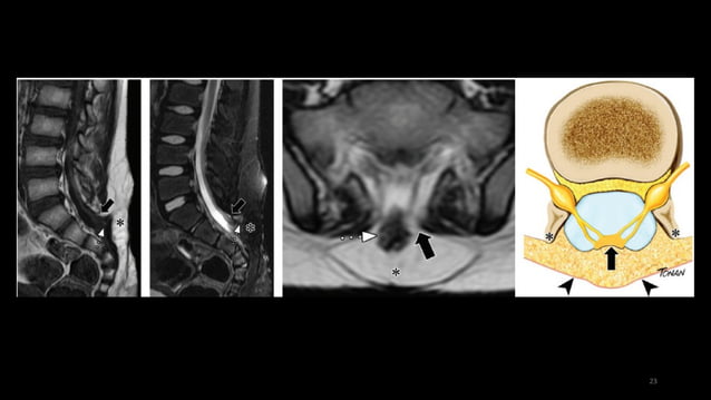 RADIOLOGICAL IMAGING IN CASES OF SPINAL DYSRAPHISM | PPT