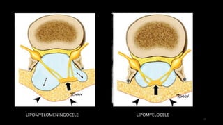RADIOLOGICAL IMAGING IN CASES OF SPINAL DYSRAPHISM | PPTX