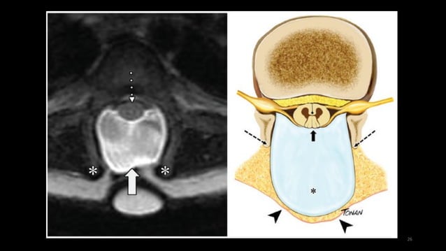 Radiological Imaging In Cases Of Spinal Dysraphism Ppt